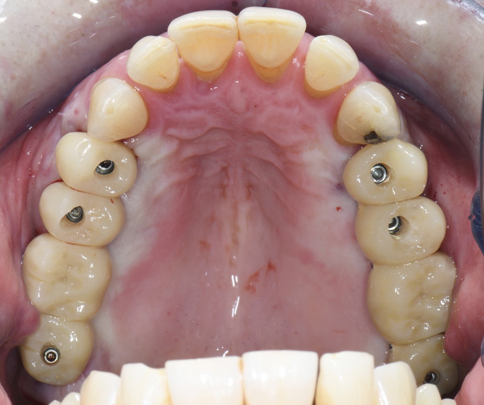 Immediate loading of the posterior maxilla